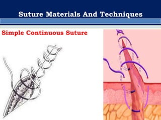 Suturing technique | PDF | Surgery | Medical Health