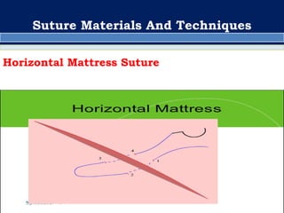 Suturing technique | PDF