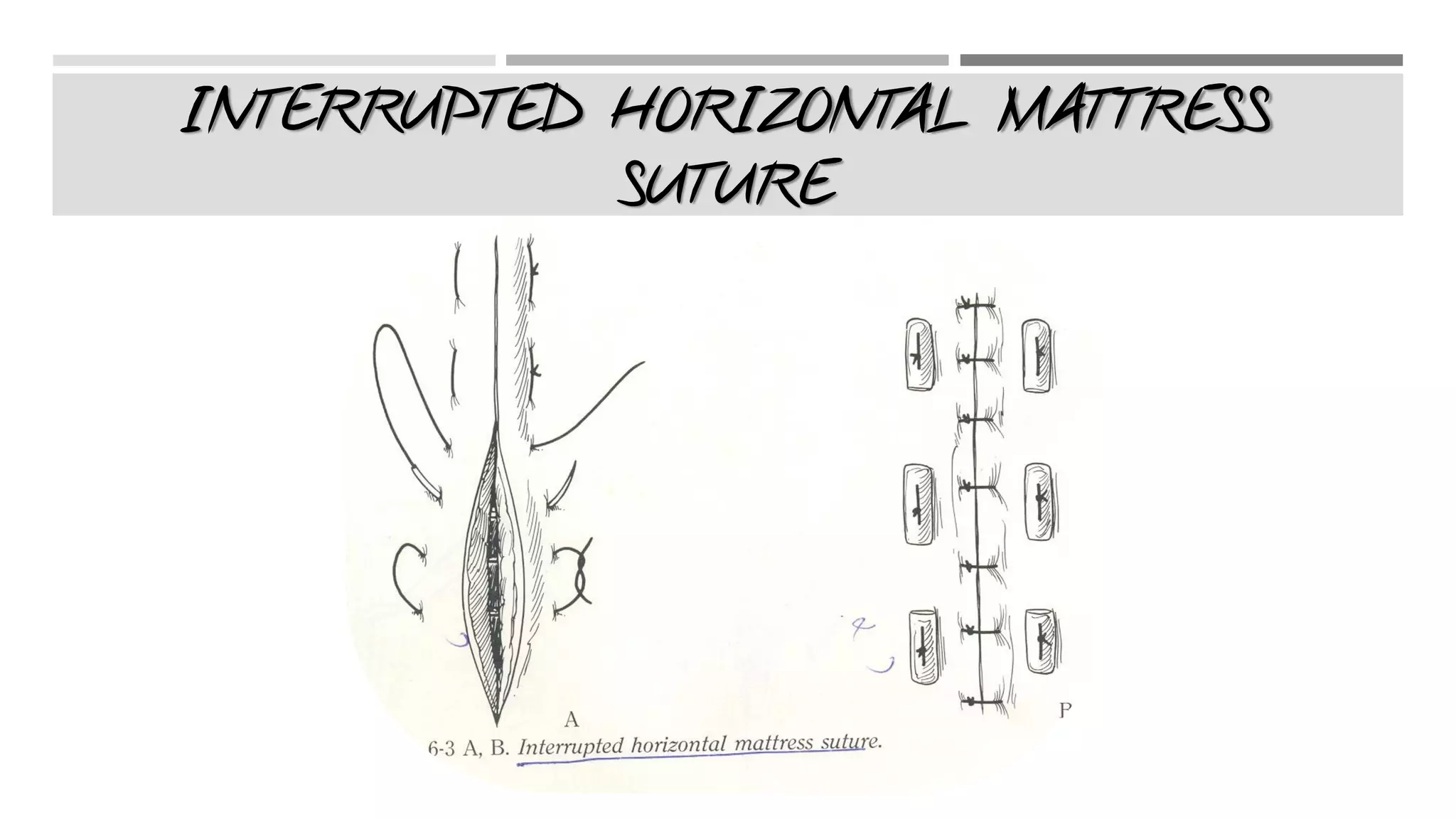 Suturing Techniques | PDF