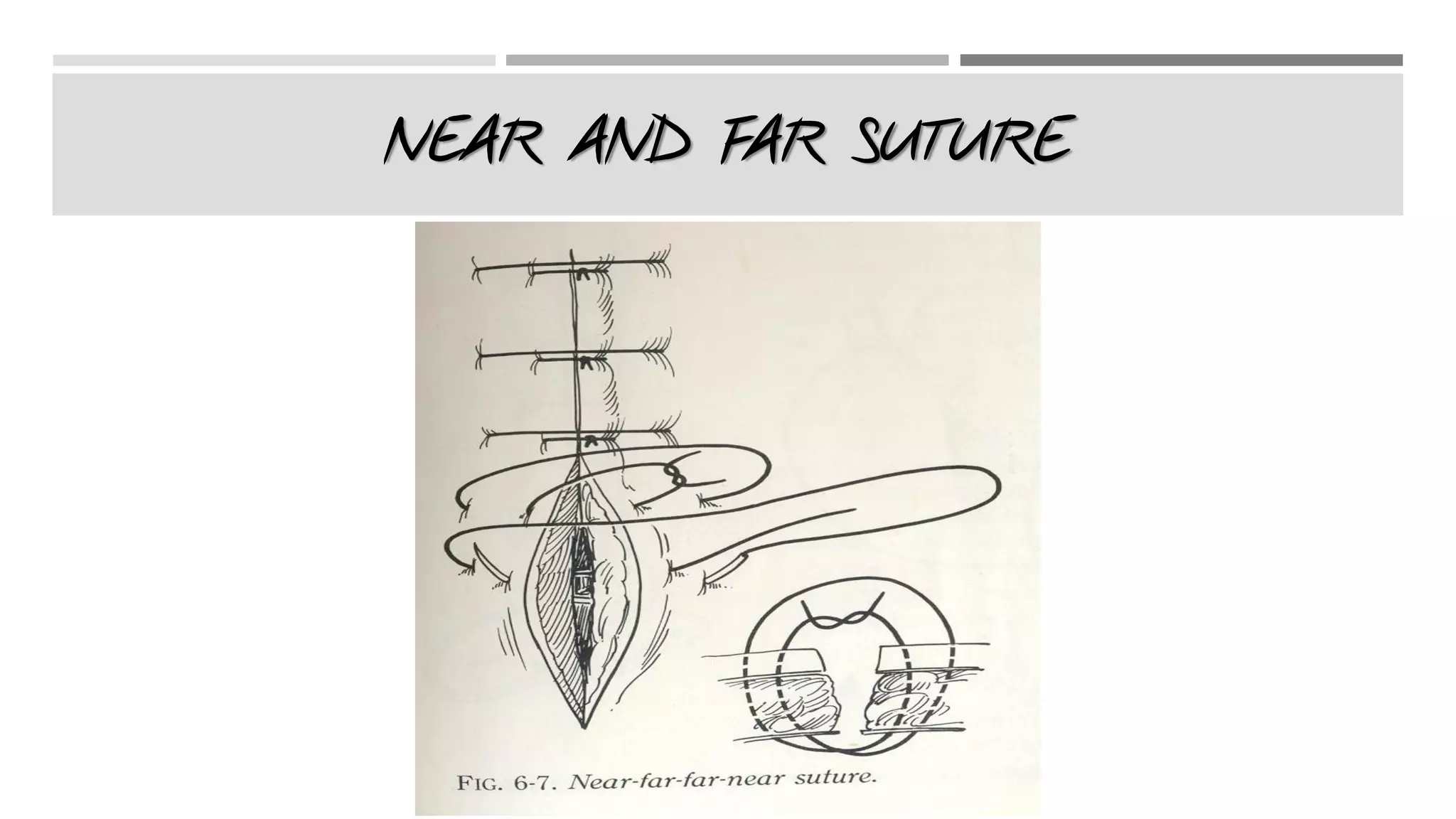 Suturing Techniques Pdf