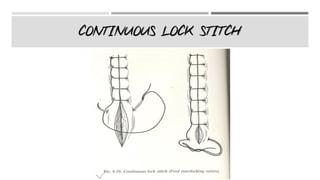 Lock Stitch Suture