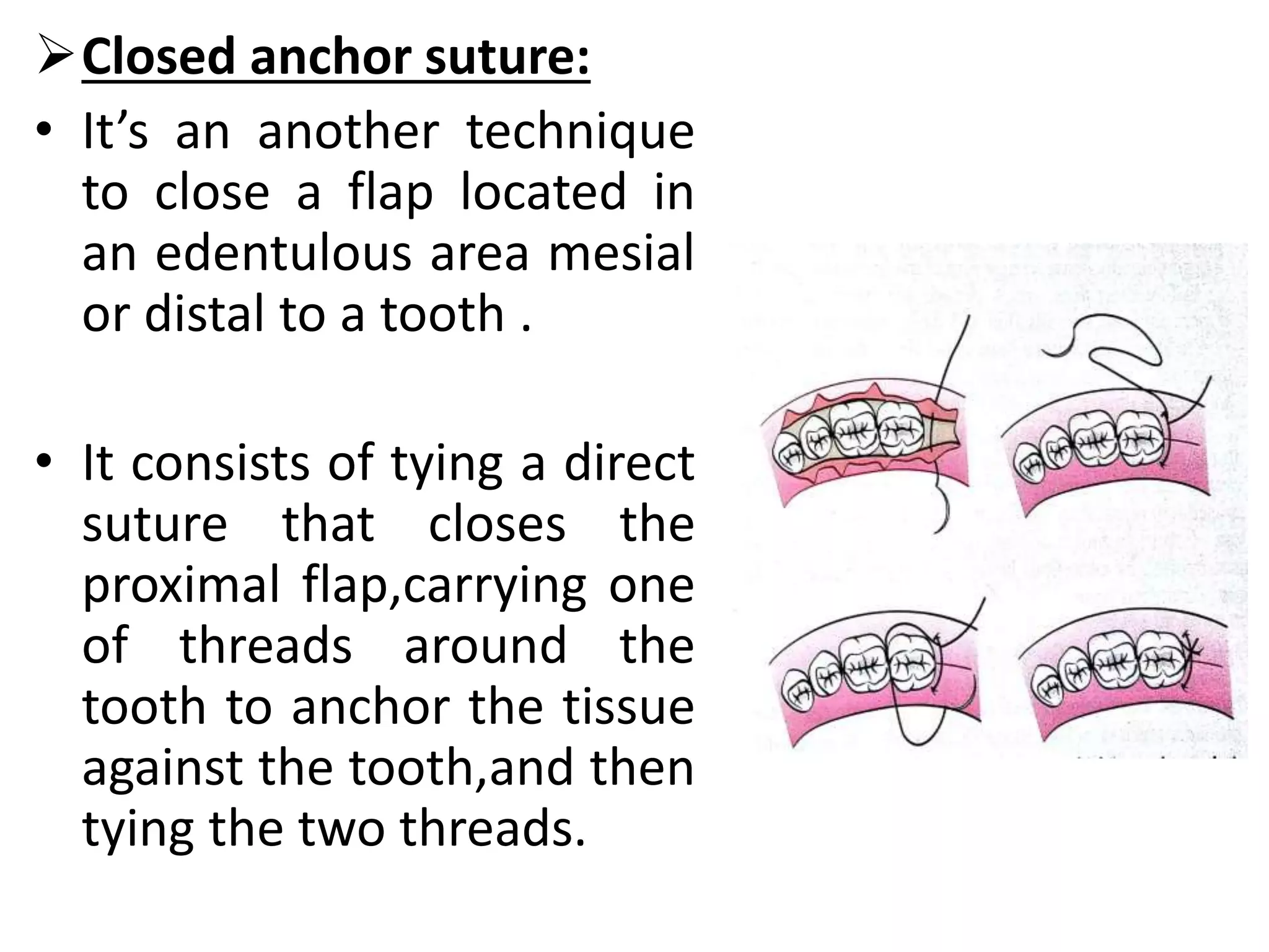 Suturing techniques ppt | PPTX