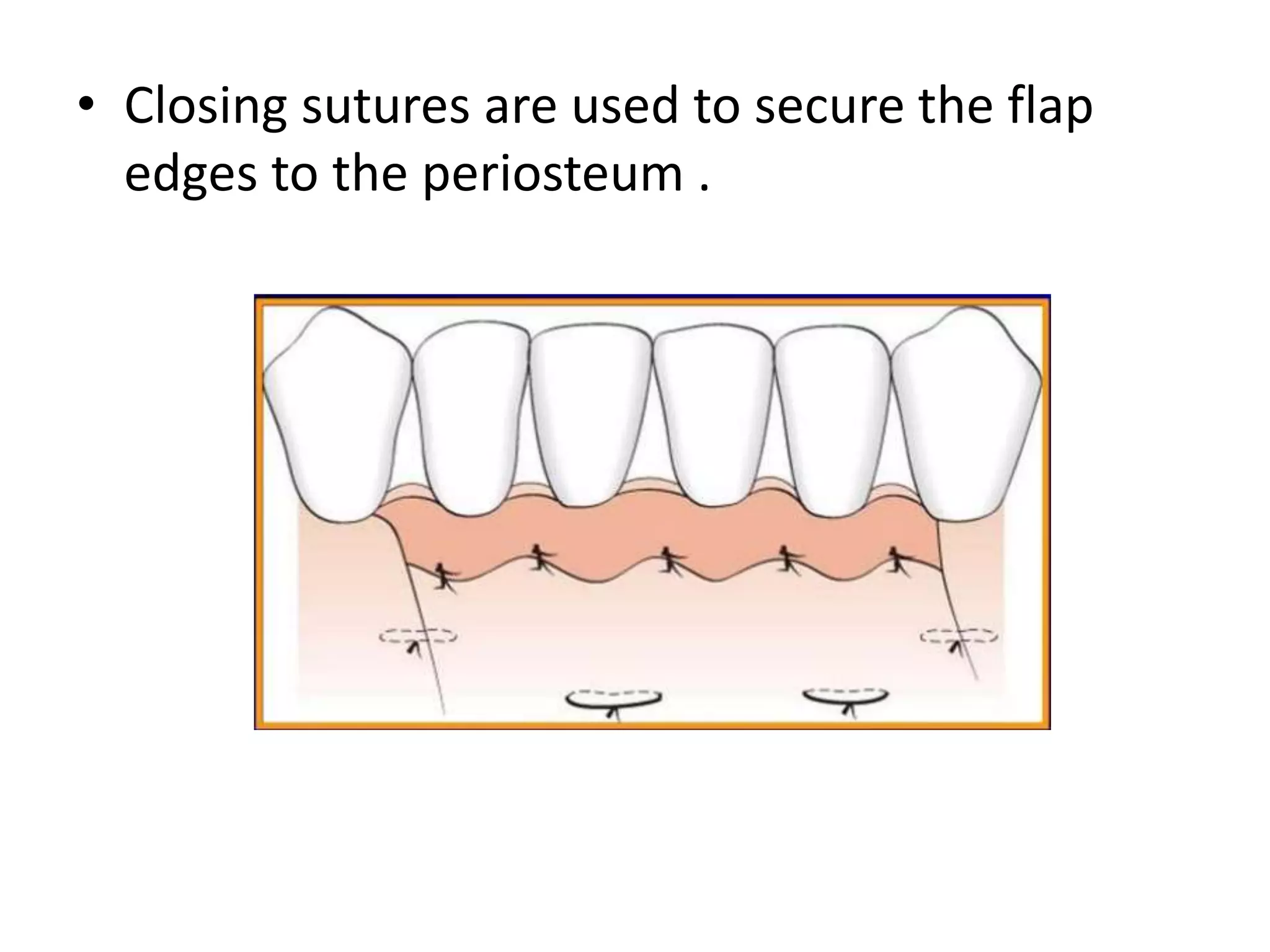 Suturing techniques ppt | PPTX