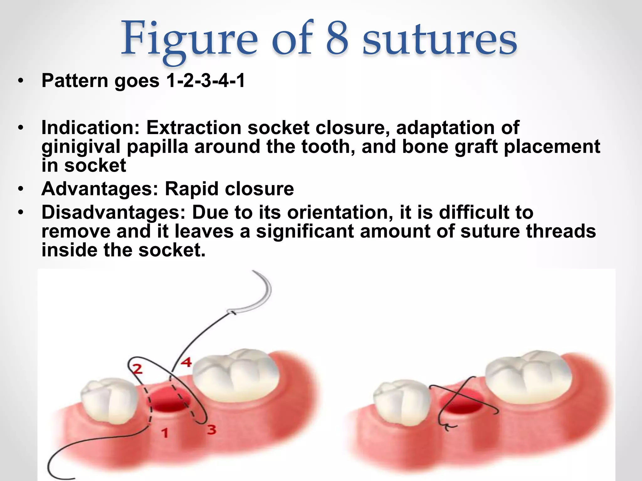 Suturing techniques involved in dental surgery | PPTX