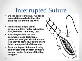 Interrupted Sutures