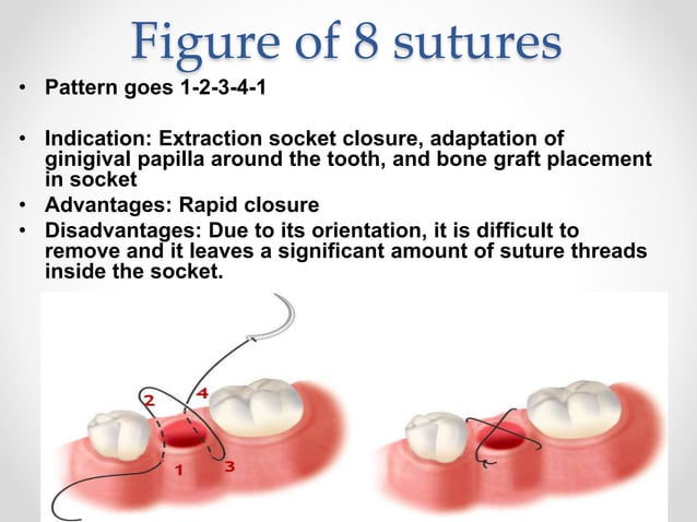 Suturing techniques involved in dental surgery