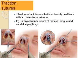Sutures, Incisions and Mesh.ppt