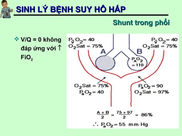 Suy hô hấp sơ sinh | PPT