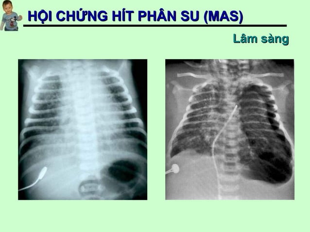 Suy hô hấp sơ sinh | PPT
