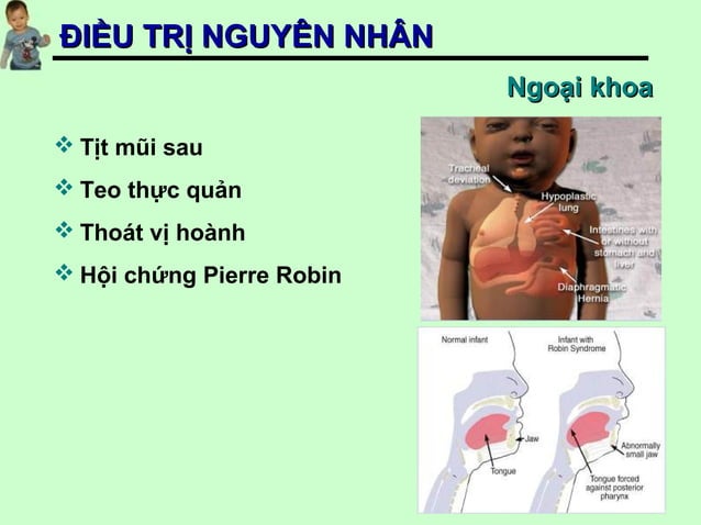 Suy hô hấp sơ sinh | PPT