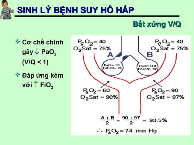Suy hô hấp sơ sinh | PPT