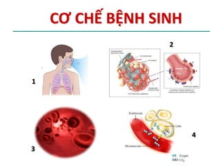 Suy ho hap so sinh bs khai