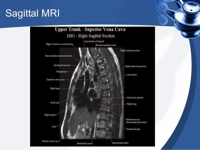 SUPERIOR VENA CAVA SYNDROME v&v PANCOAST SYNDROME