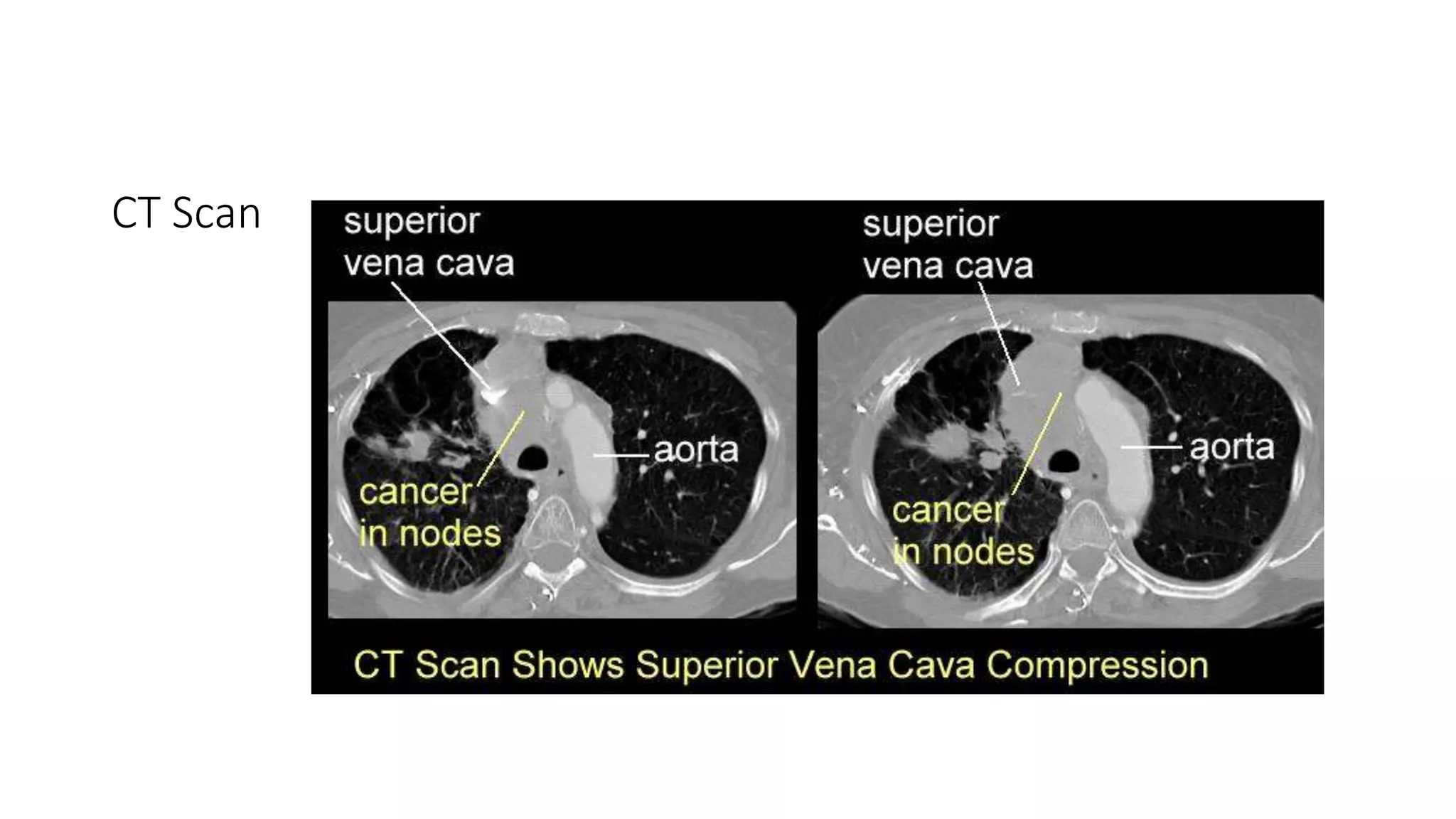 supra vena cava obstruction (SVCO) | PPTX