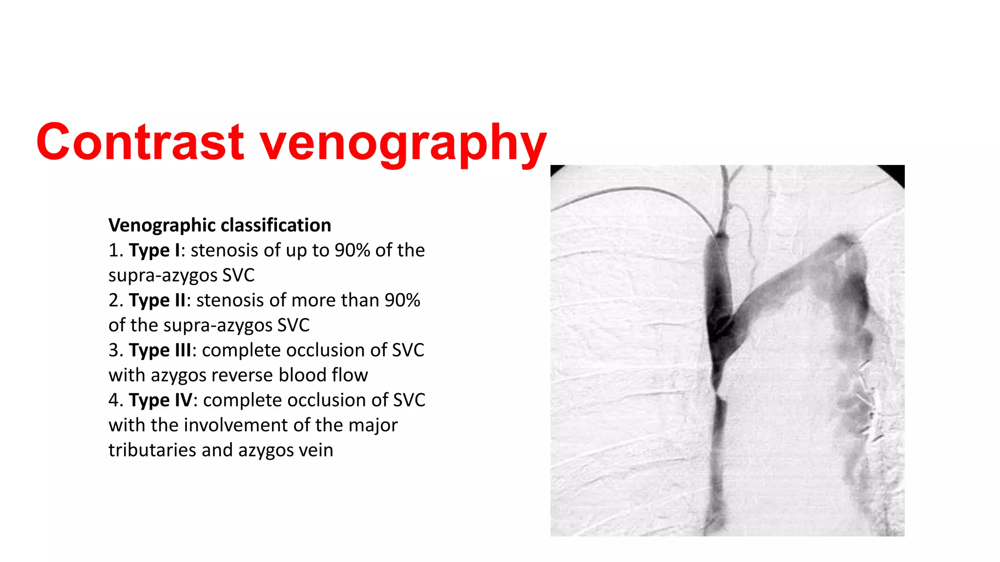 supra vena cava obstruction (SVCO) | PPTX
