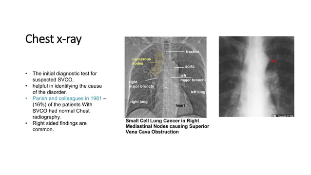 supra vena cava obstruction (SVCO) | PPTX