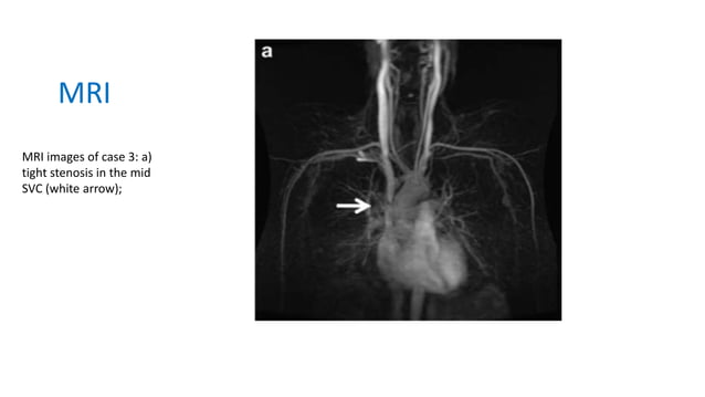 supra vena cava obstruction (SVCO) | PPTX