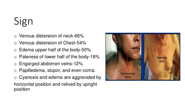 supra vena cava obstruction (SVCO)