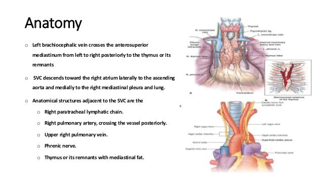 supra vena cava obstruction (SVCO)