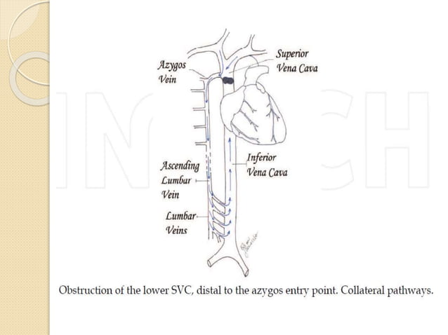 Svc obstruction | PPTX