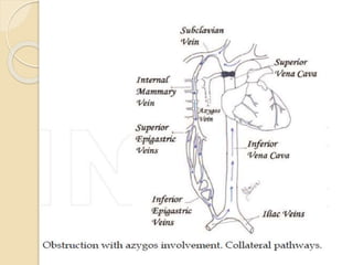 Superior Vena Cava Syndrome Collateral Circulation