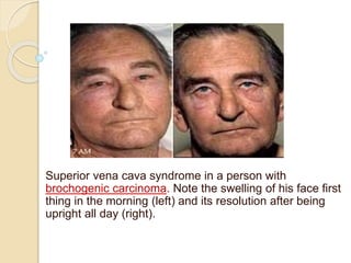 Superior Vena Cava Syndrome Face