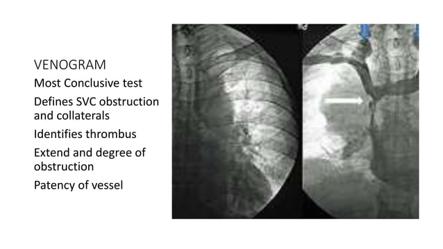 SVC syndrome | PPT