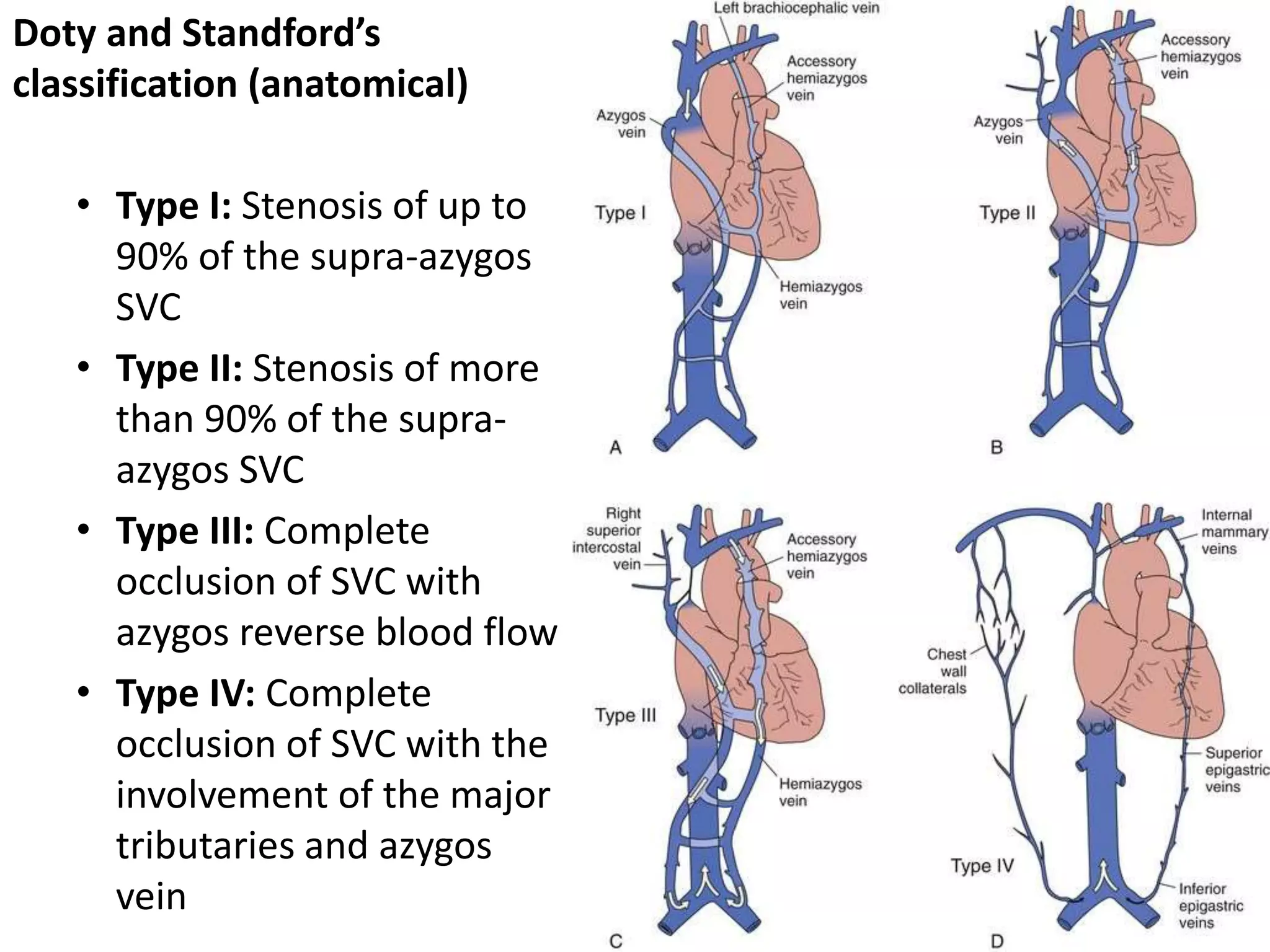 Superior vena cava syndrome | PPTX