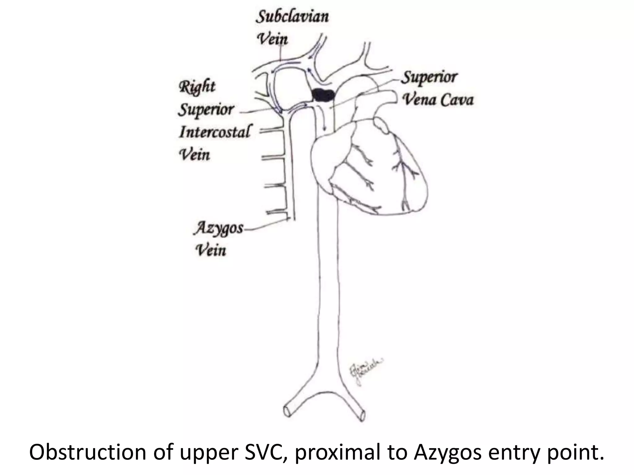 Superior vena cava syndrome | PPTX