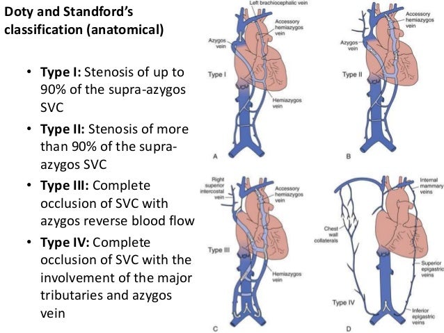 Superior vena cava syndrome