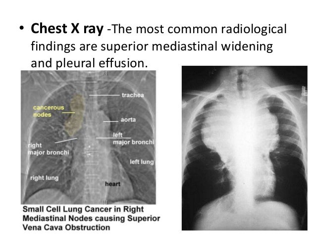 Figure 1 From A Case Of Superior Vena Cava Syndrome