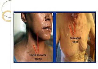 Svc syndrome, | PPTX | Lung and Respiratory Health | Diseases and ...