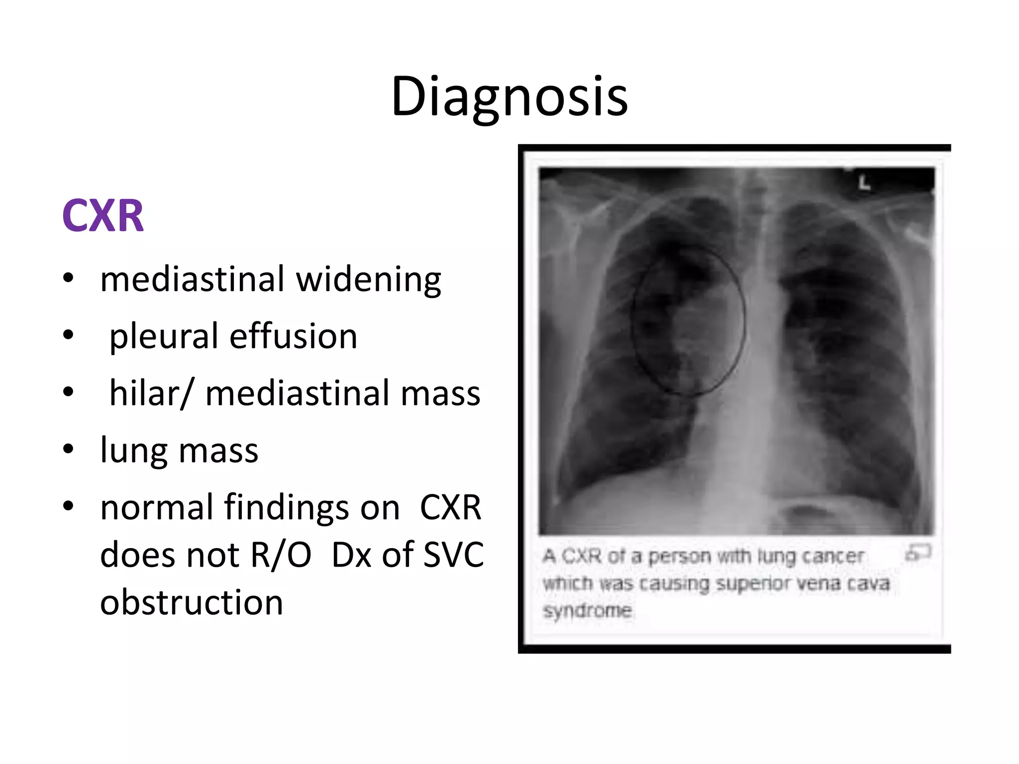 management of superior vena cava syndrome,SVCS | PPTX