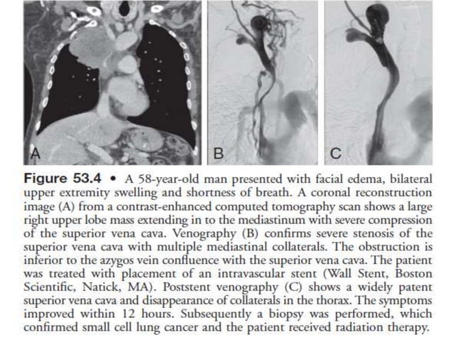 management of superior vena cava syndrome,SVCS | PPTX | Heart and ...