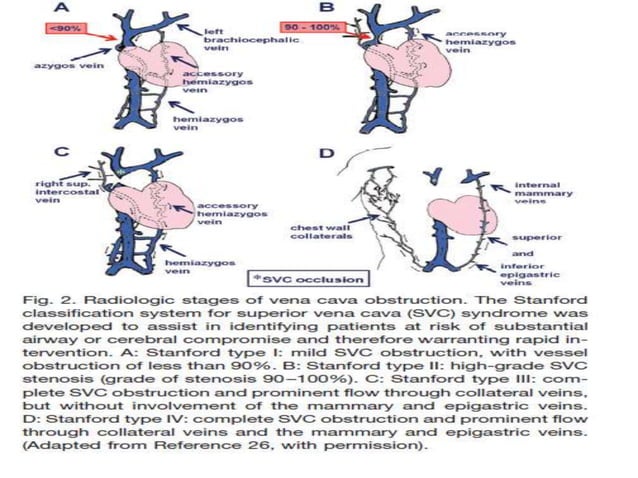 management of superior vena cava syndrome,SVCS | PPTX | Heart and ...