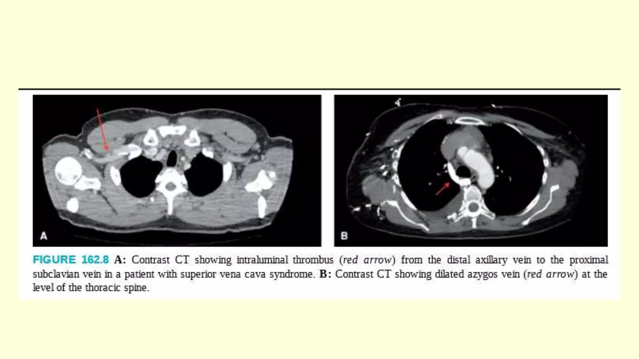 SVC syndrome - a surgical perspective | PPT