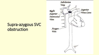 SVC syndrome - a surgical perspective | PPTX