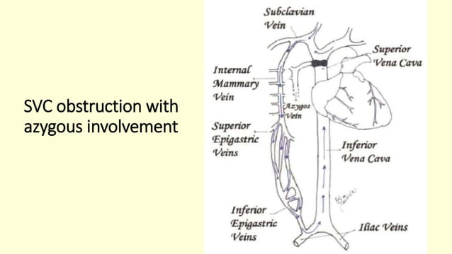 SVC syndrome - a surgical perspective | PPT