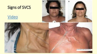 SVC syndrome - a surgical perspective | PPTX