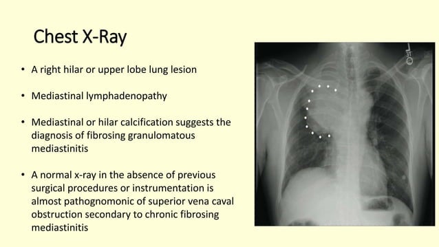SVC syndrome - a surgical perspective | PPT