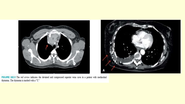 SVC syndrome - a surgical perspective | PPT