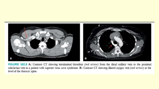 SVC syndrome - a surgical perspective | PPT