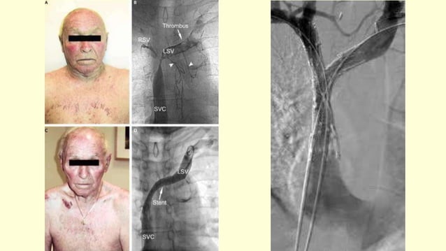 SVC syndrome - a surgical perspective | PPT