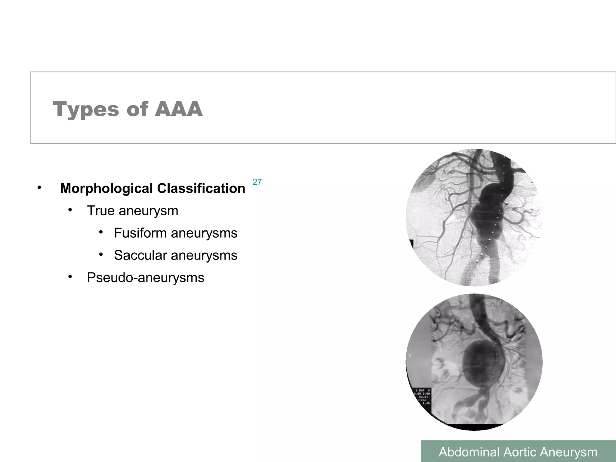 Abdominal Aortic Aneurysm | PPT