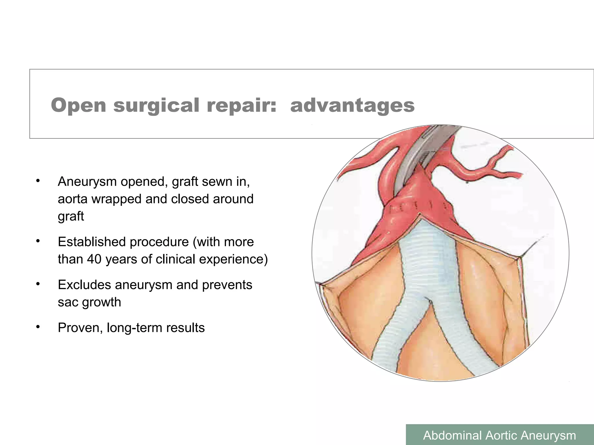 Abdominal Aortic Aneurysm | PPT