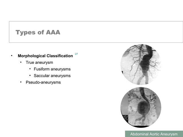 Abdominal Aortic Aneurysm | PPT | Digestive Disorders | Diseases and Conditions