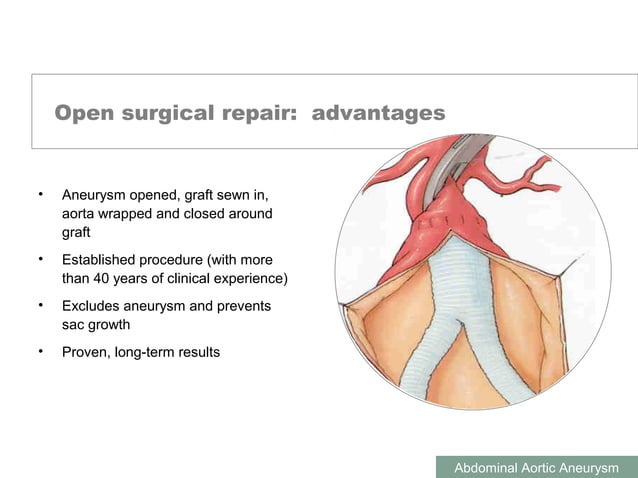 Abdominal Aortic Aneurysm | PPT | Digestive Disorders | Diseases and Conditions