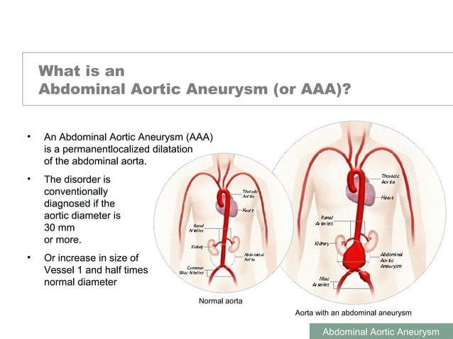 Abdominal Aortic Aneurysm | PPT | Digestive Disorders | Diseases and Conditions