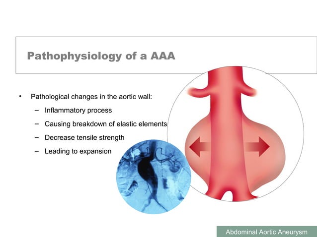 Abdominal Aortic Aneurysm | PPT | Digestive Disorders | Diseases and Conditions
