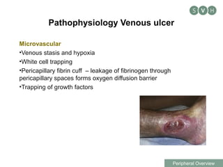 Assessment of leg ulcers and advances in endovascular treatment | PPT